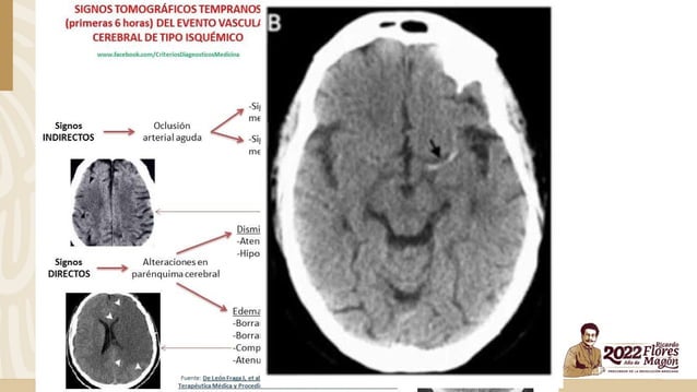 Evento vascular cerebral isquémico 1.pptx