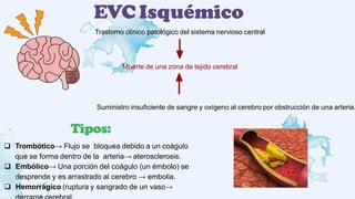 EVC isquémica.pdf
