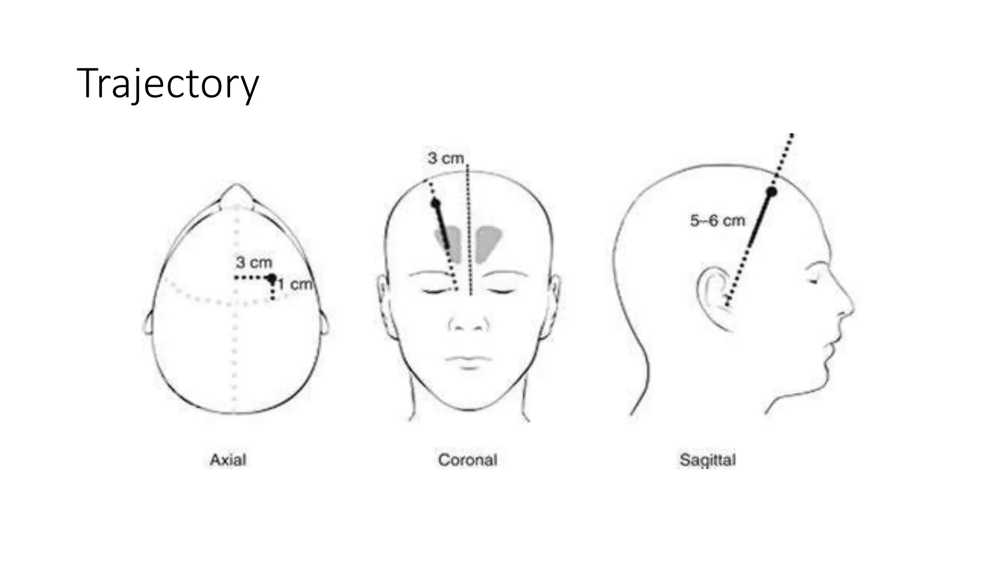 External Ventricular Drain Evd Pptx