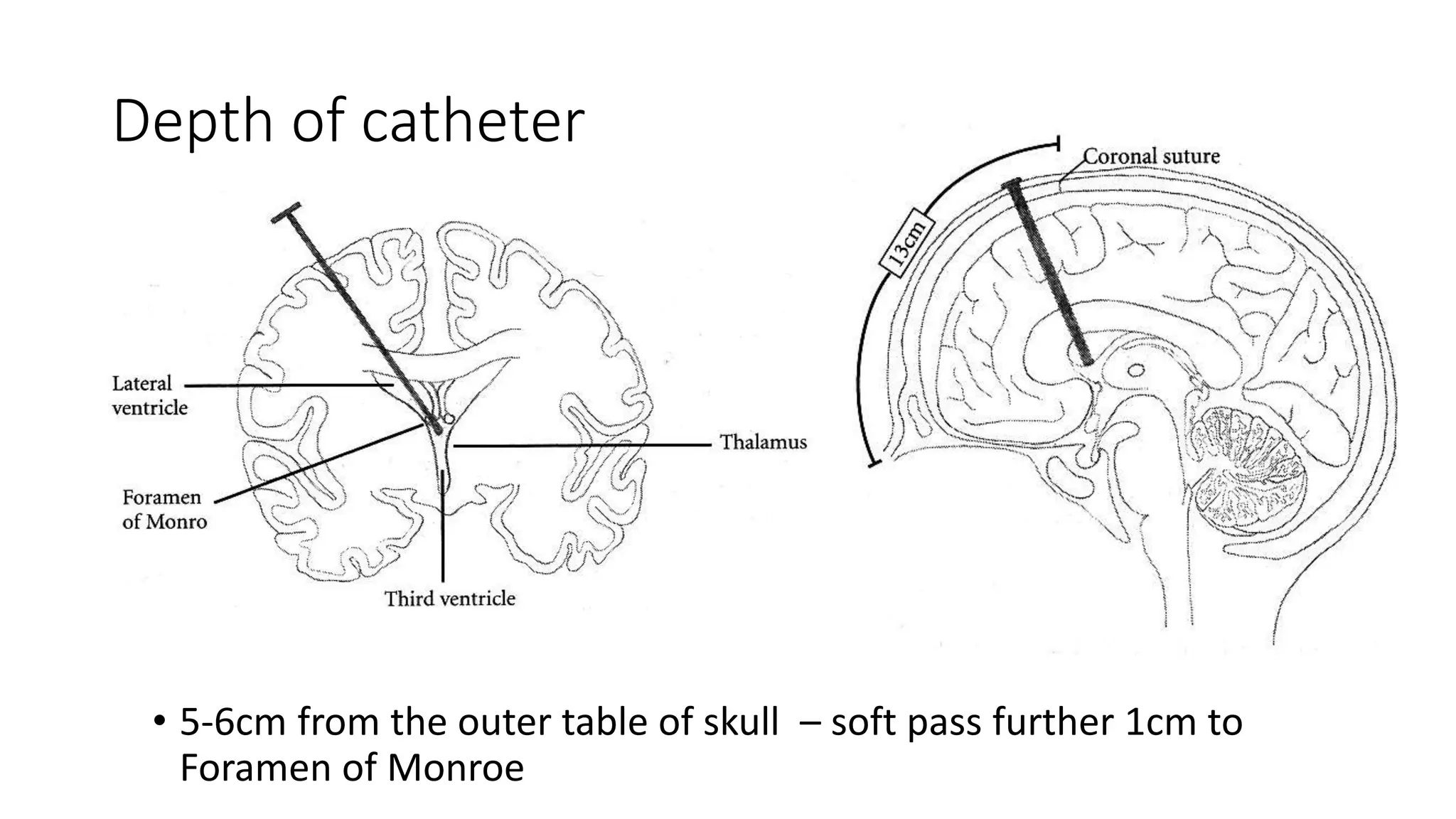 External Ventricular Drain (EVD) | PPTX
