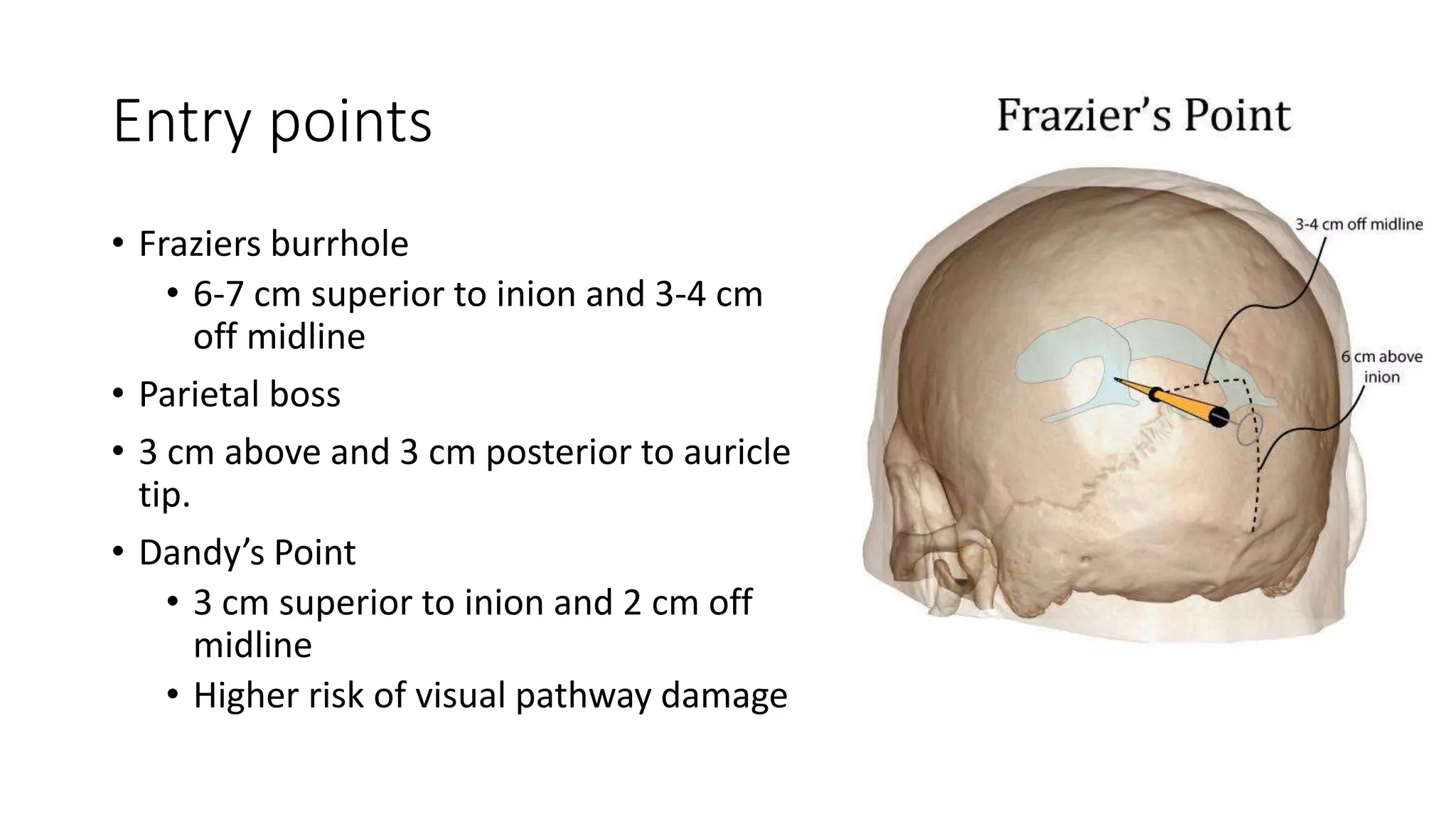 External Ventricular Drain (EVD) | PPTX