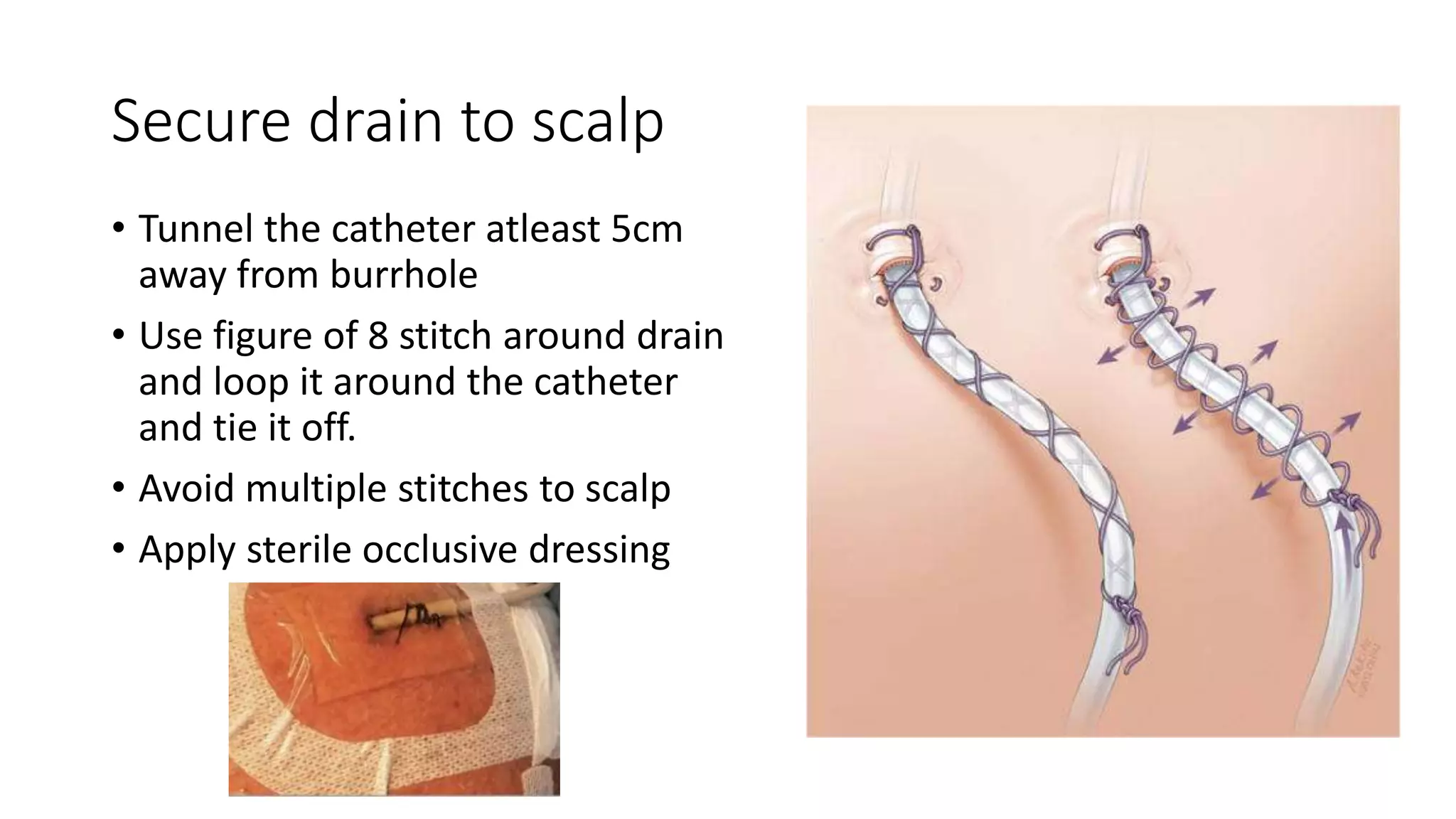 External Ventricular Drain (EVD) | PPTX