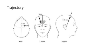 External Ventricular Drain (EVD) | PPTX