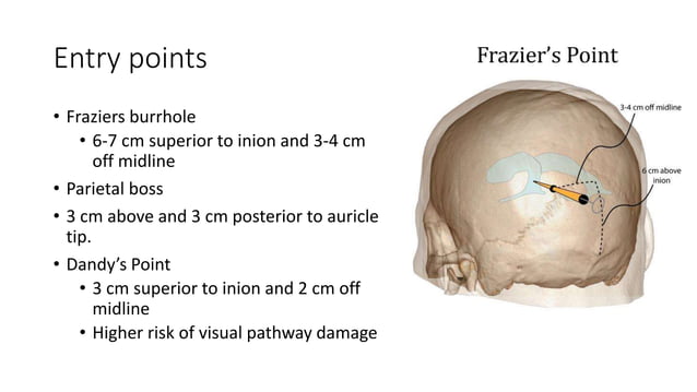 External Ventricular Drain (EVD) | PPTX