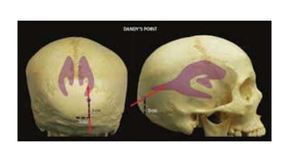 External Ventricular Drain (EVD) | PPTX