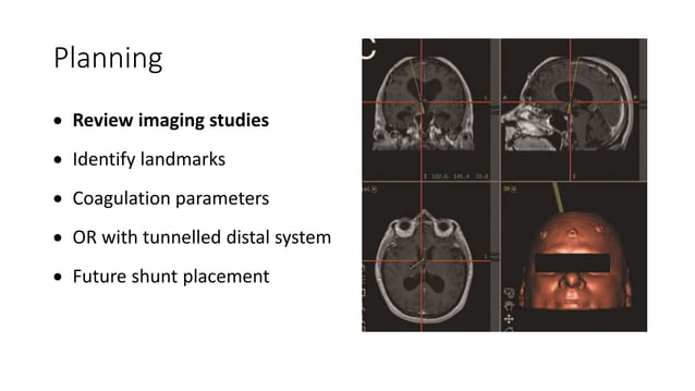 External Ventricular Drain (EVD) | PPTX