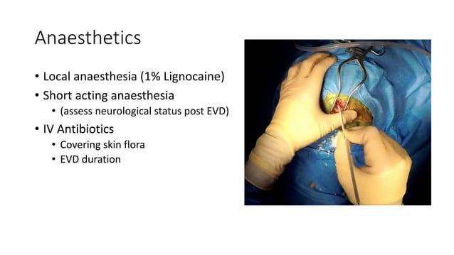 External Ventricular Drain (EVD) | PPTX