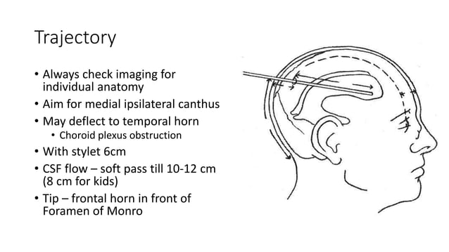 External Ventricular Drain (EVD) | PPT
