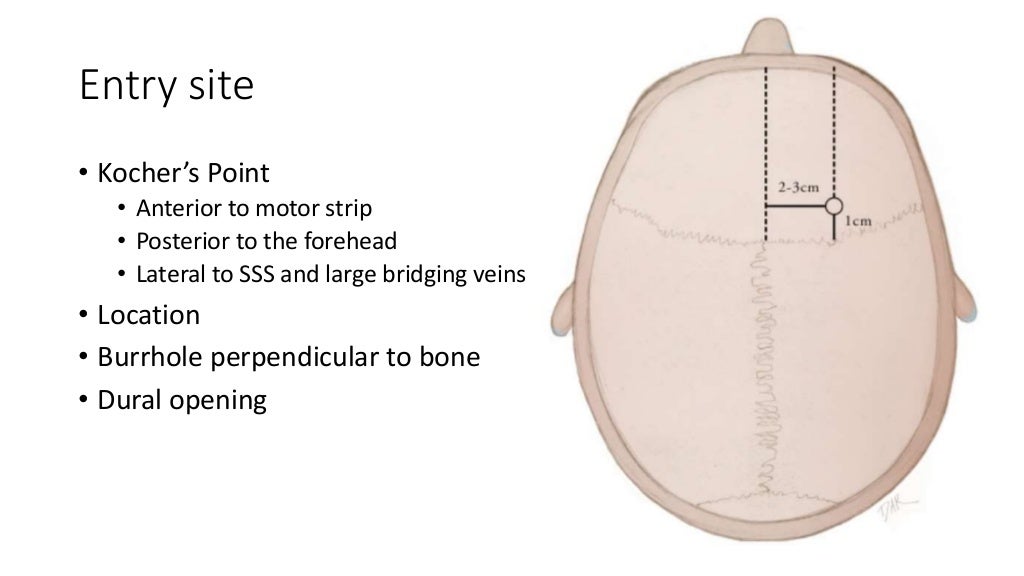 External Ventricular Drain (EVD)
