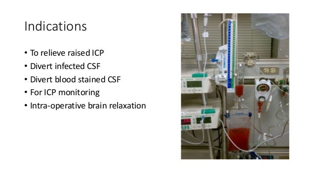 External Ventricular Drain (EVD)