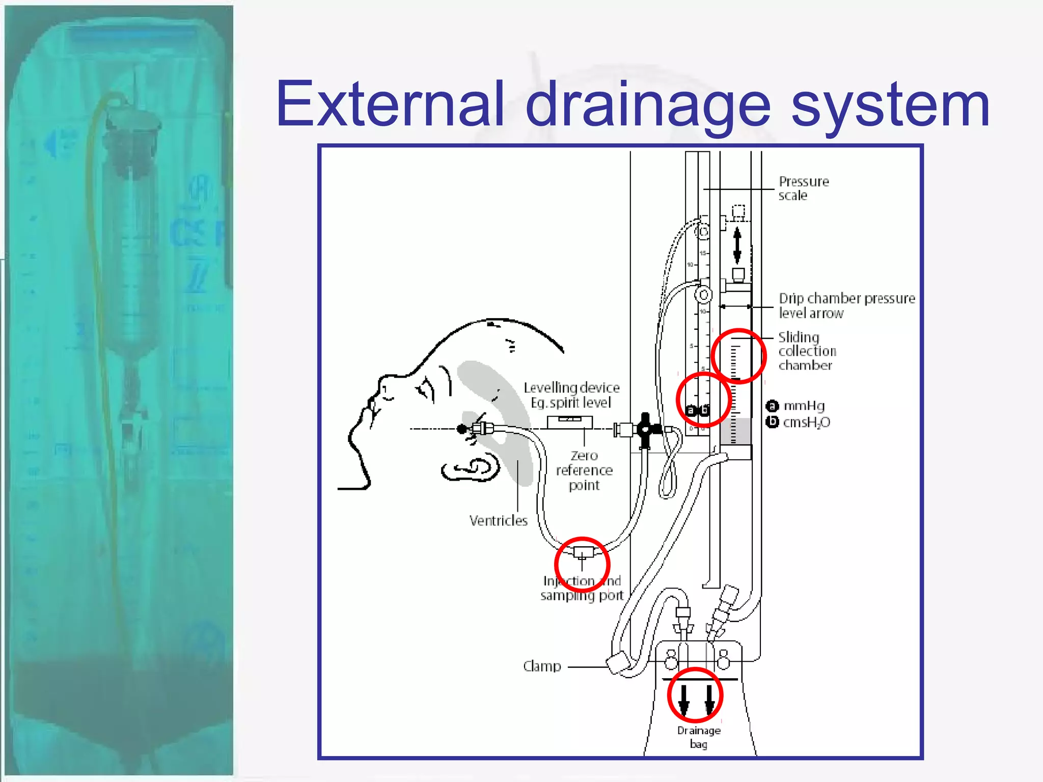 External Ventricular Drain | PPT