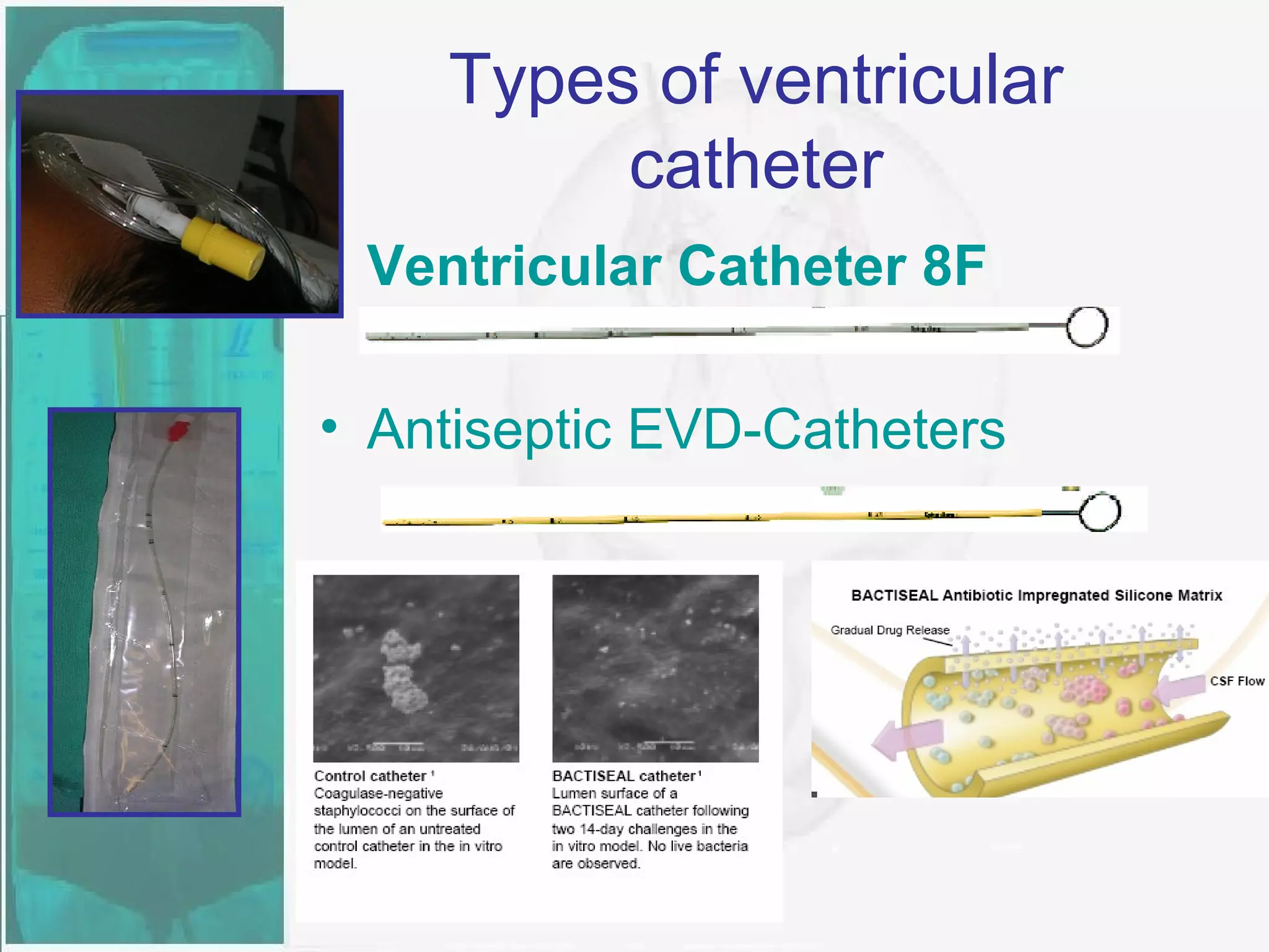 External Ventricular Drain | PPT
