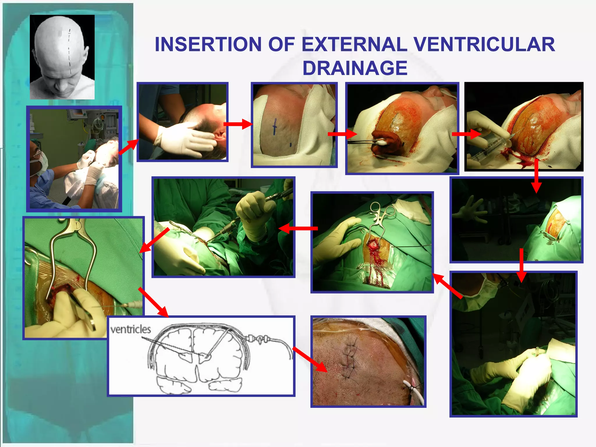 External Ventricular Drain | PPT