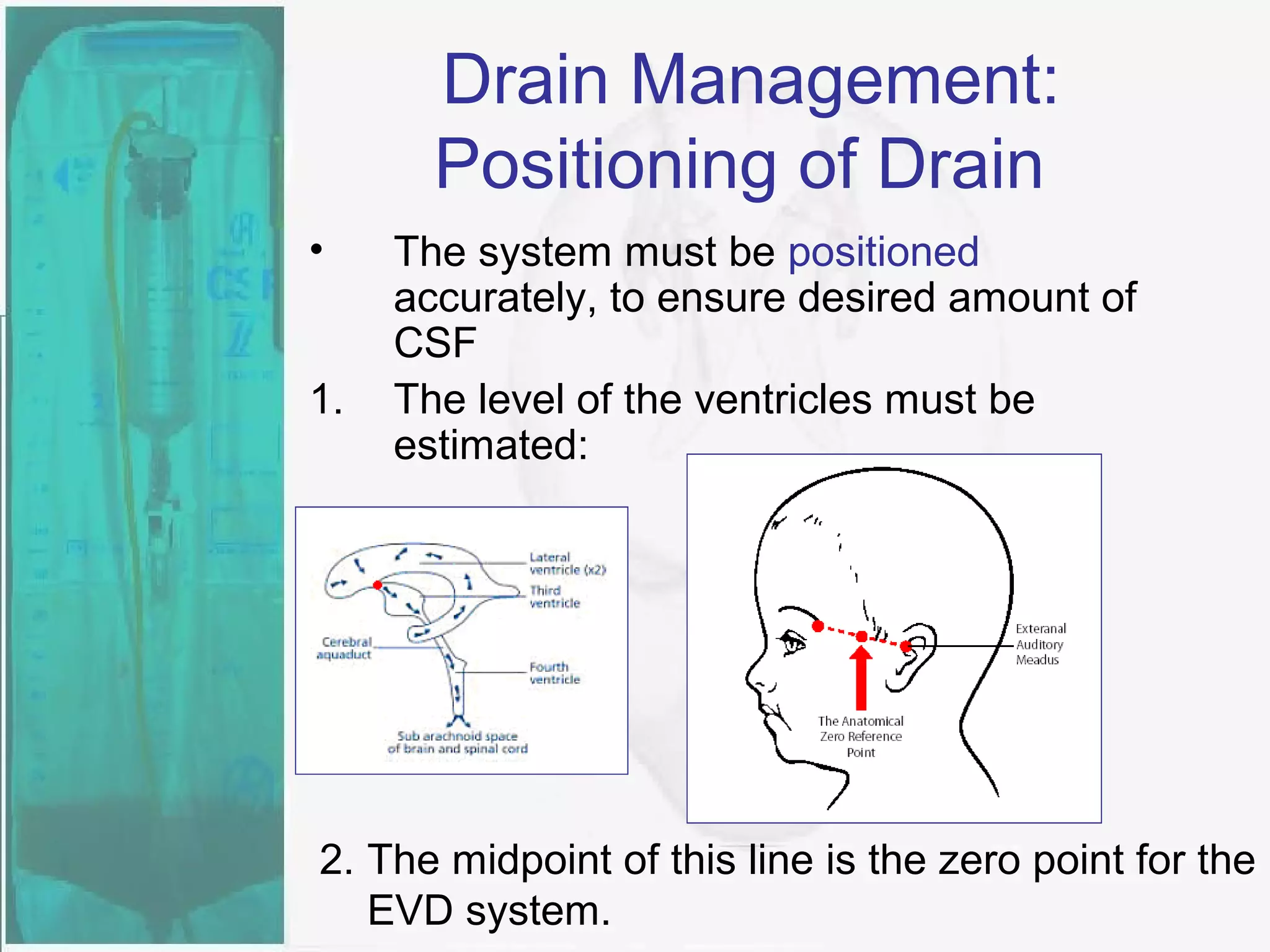 External Ventricular Drain | PPT