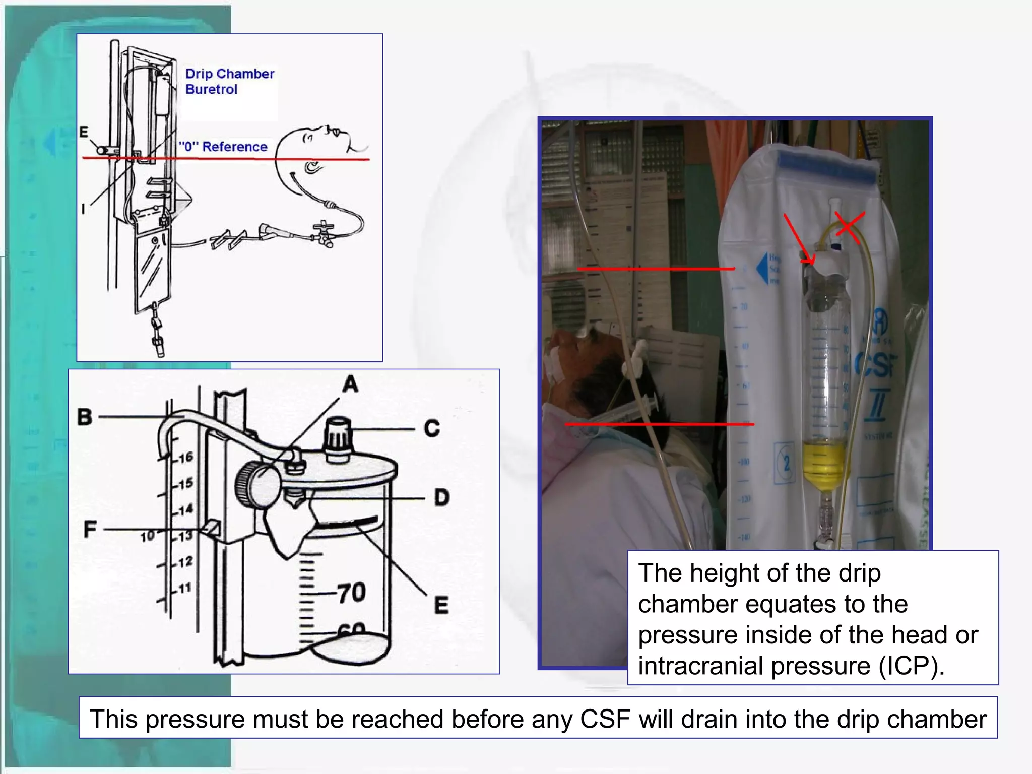 External Ventricular Drain | PPT