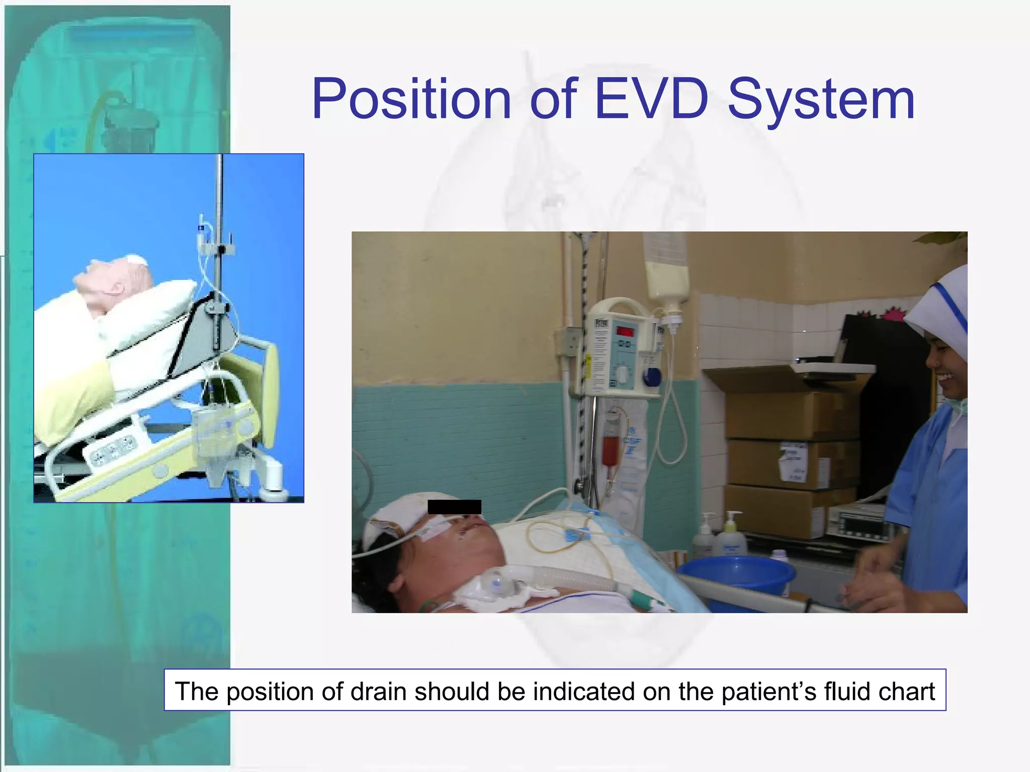 External Ventricular Drain | PPT