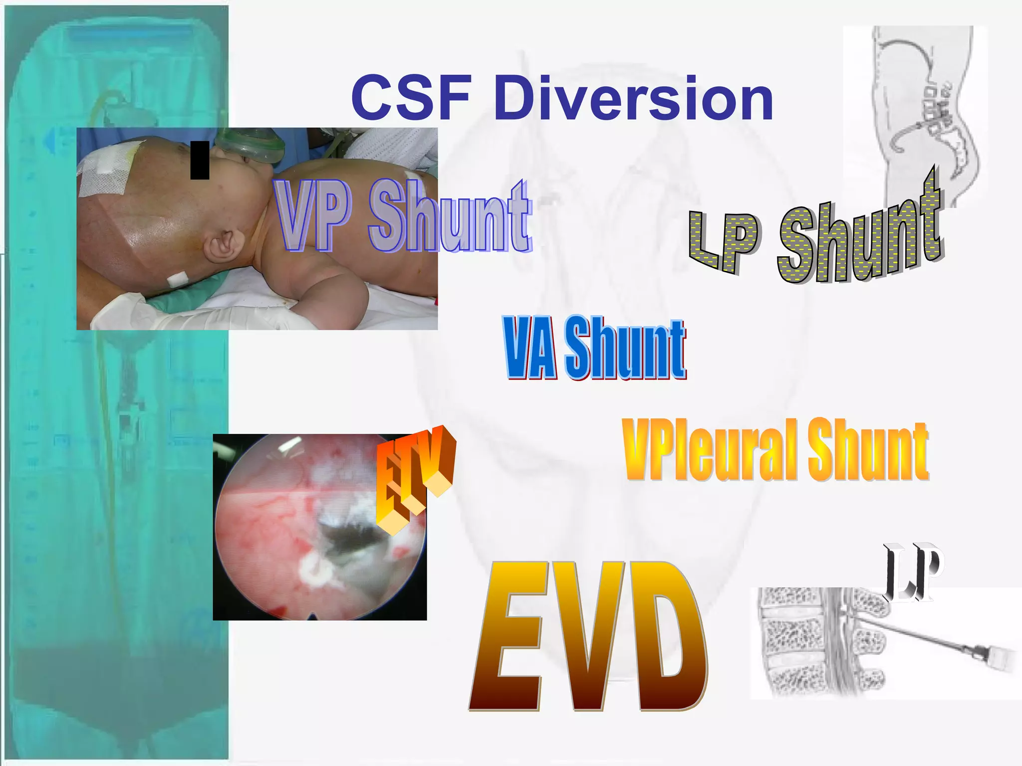 External Ventricular Drain | PPT