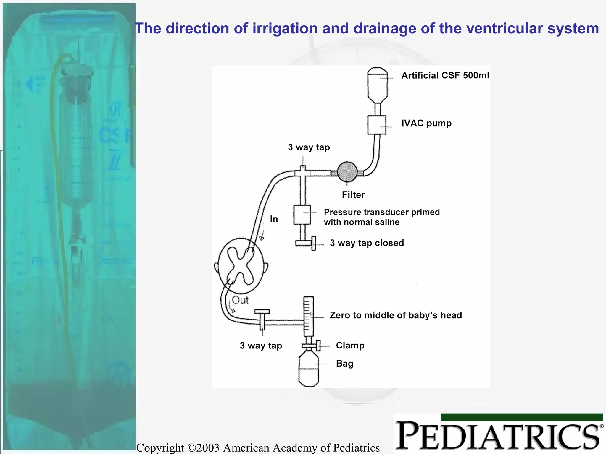 External Ventricular Drain | PPT