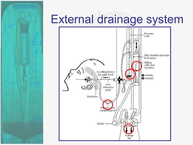 External Ventricular Drain | PPT