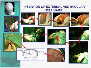 External Ventricular Drain | PPT