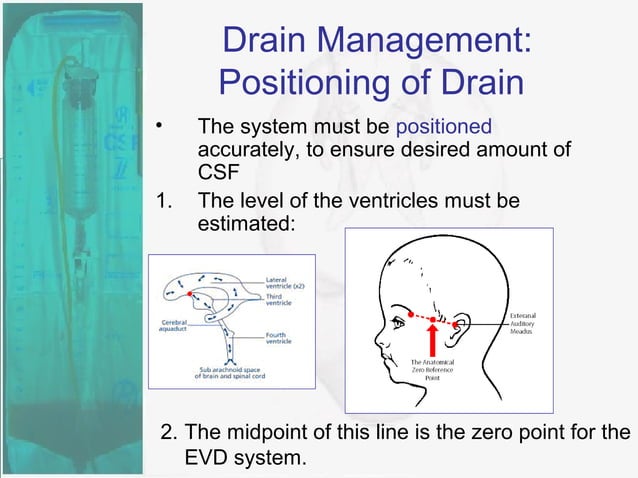 External Ventricular Drain | PPT