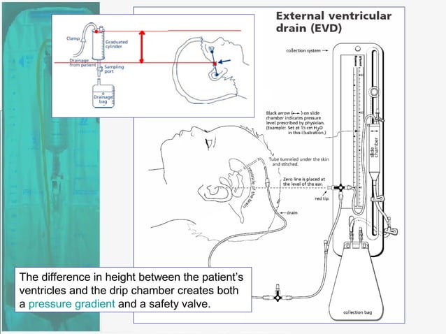 External Ventricular Drain | PPT