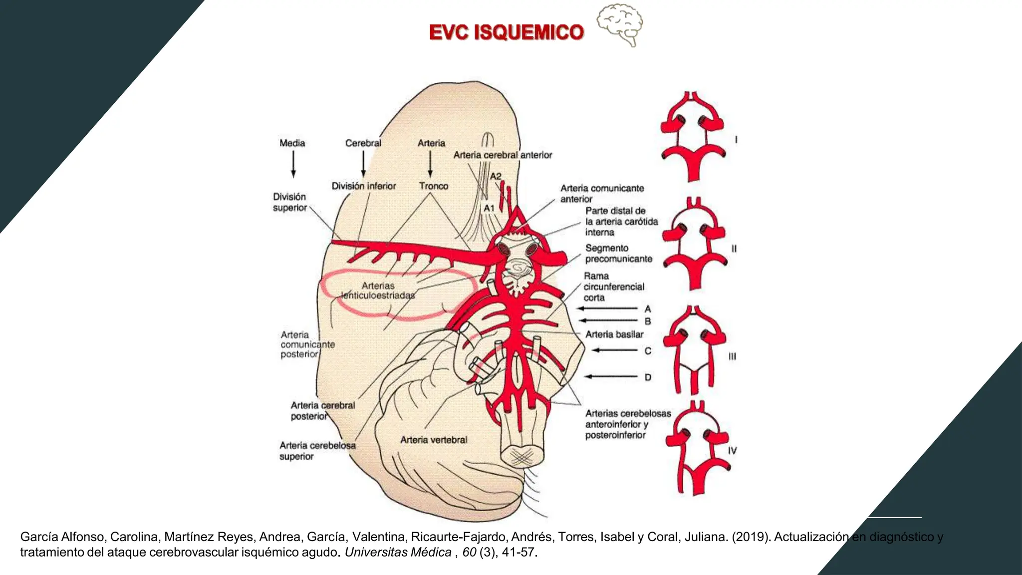 Evento vascular Isquémico CORRECCIONES.pptx