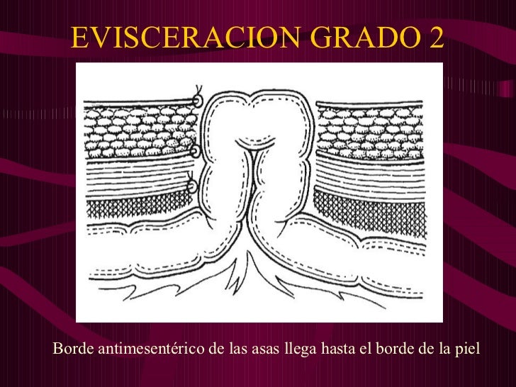 Eventraciones