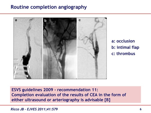 Eversion or standard carotid endarterectomy local or general anesthesia ...