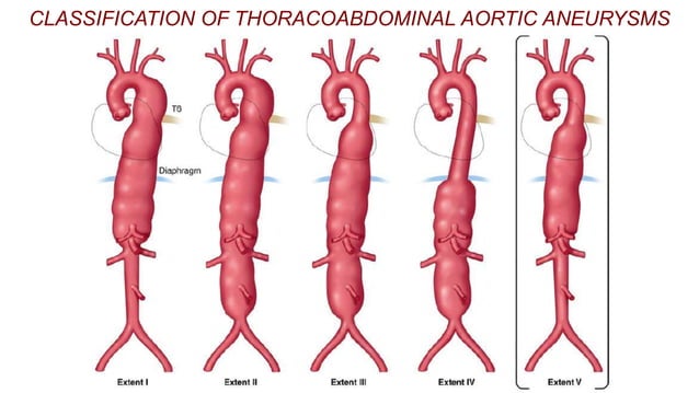 SURGICAL MANAGEMENT of thoracic abdominal aortic aneurysms.pptx