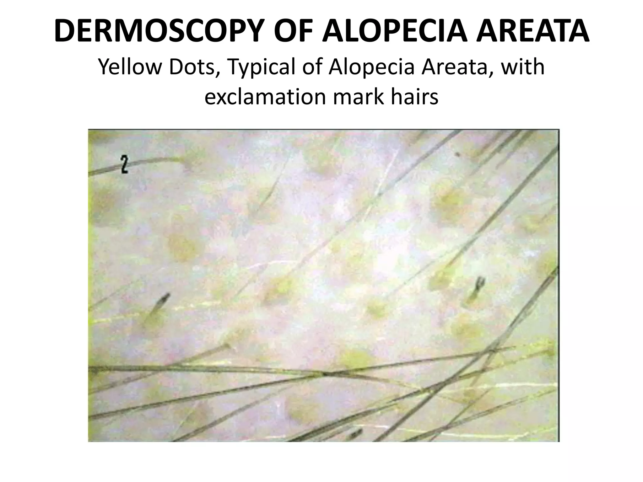 Everything you need to know about alopecia areata | PDF