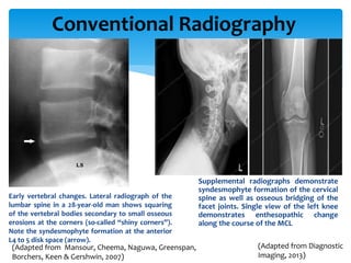 Evidence Based Practice in Medical Imaging- Ankylosing Spondylitis | PPT