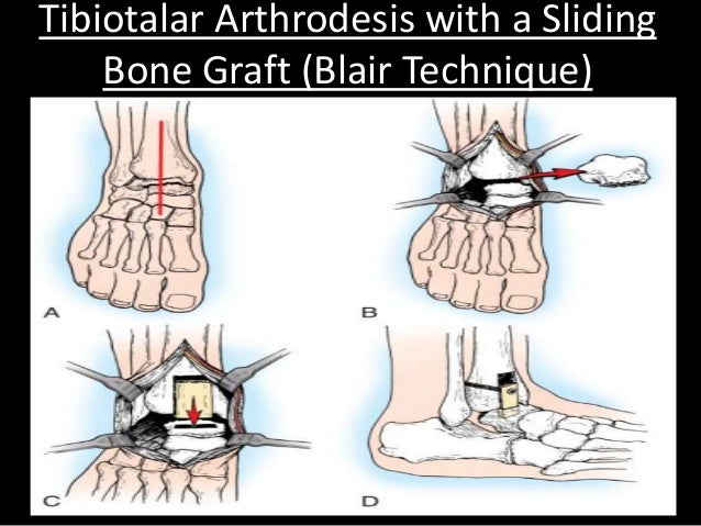 AVN Talus Treated By Retrograde Nail Fusion: A Case report