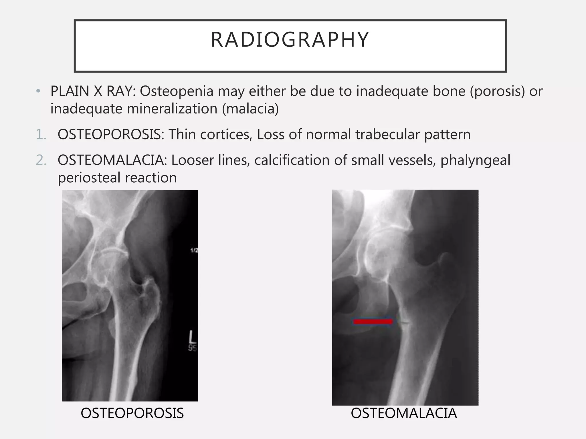 Bone tumor and Pathological fractures seminar and evidence based ...