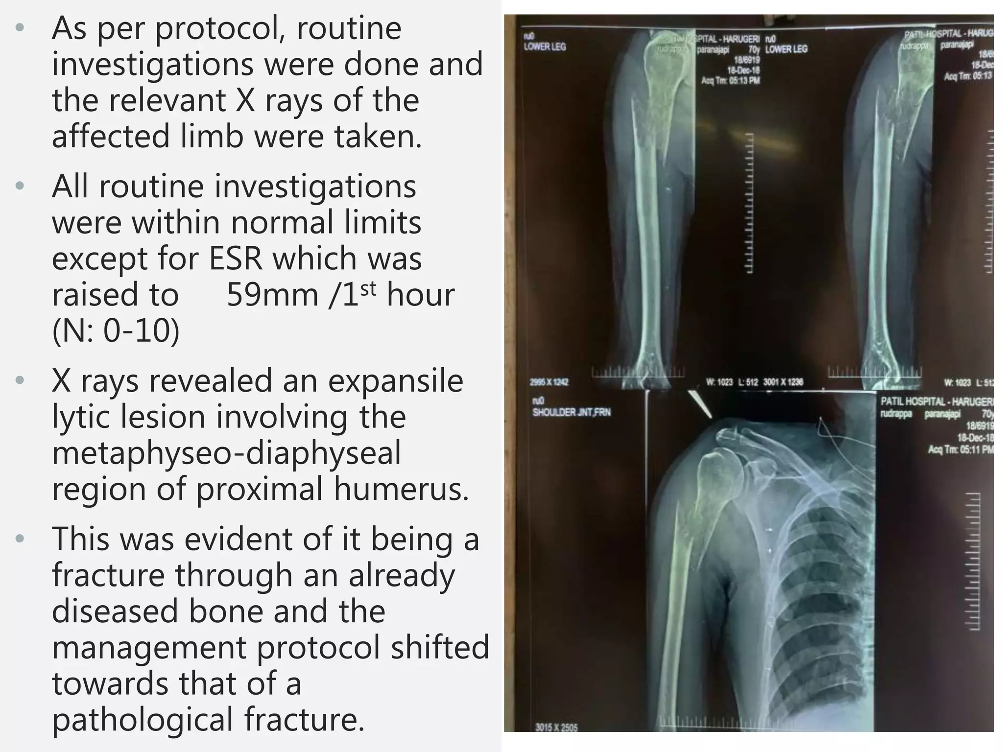 Bone tumor and Pathological fractures seminar and evidence based ...