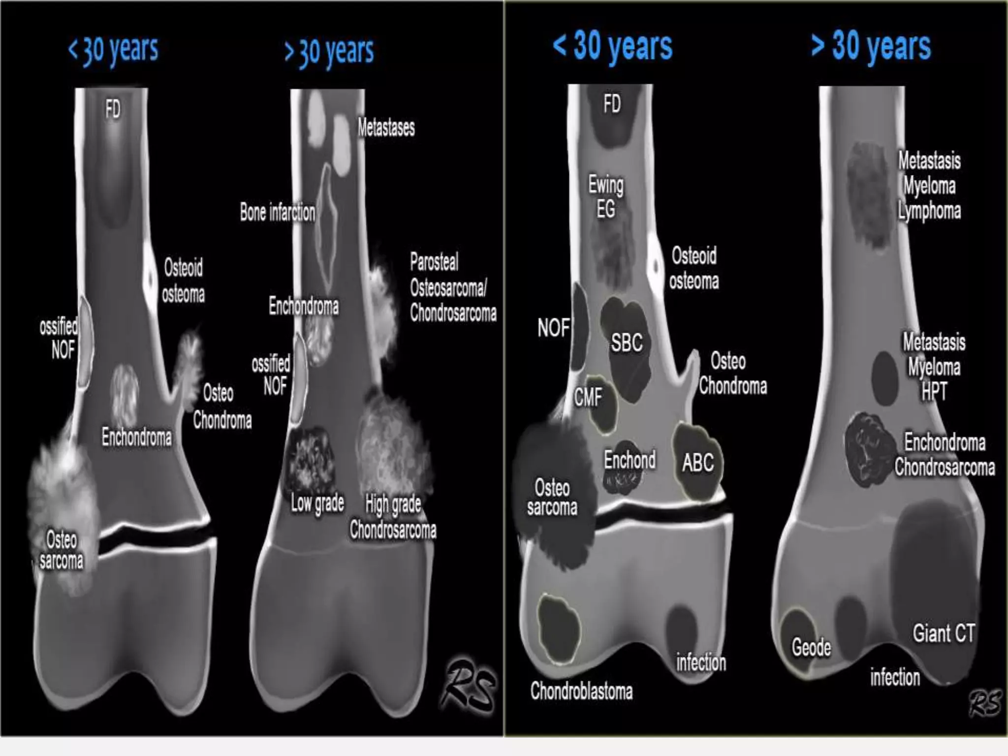 Bone tumor and Pathological fractures seminar and evidence based ...