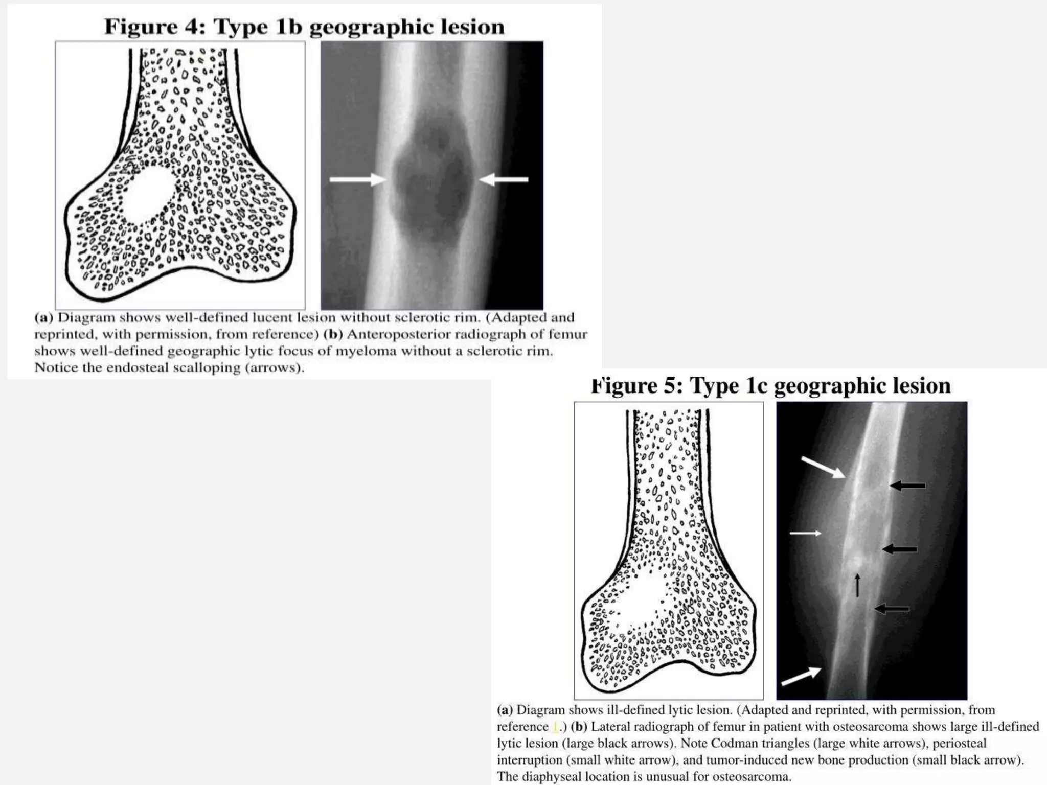 Bone tumor and Pathological fractures seminar and evidence based ...