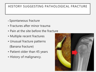 Bone tumor and Pathological fractures seminar and evidence based ...