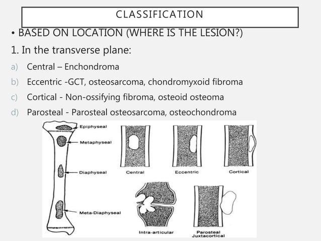 Bone tumor and Pathological fractures seminar and evidence based ...