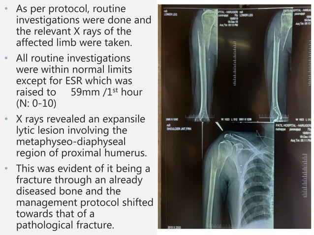 Bone tumor and Pathological fractures seminar and evidence based ...