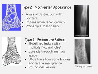 Bone tumor and Pathological fractures seminar and evidence based ...