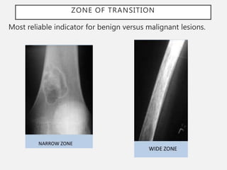 Bone tumor and Pathological fractures seminar and evidence based ...