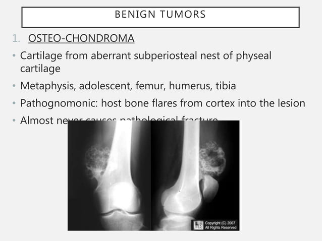 Bone tumor and Pathological fractures seminar and evidence based ...