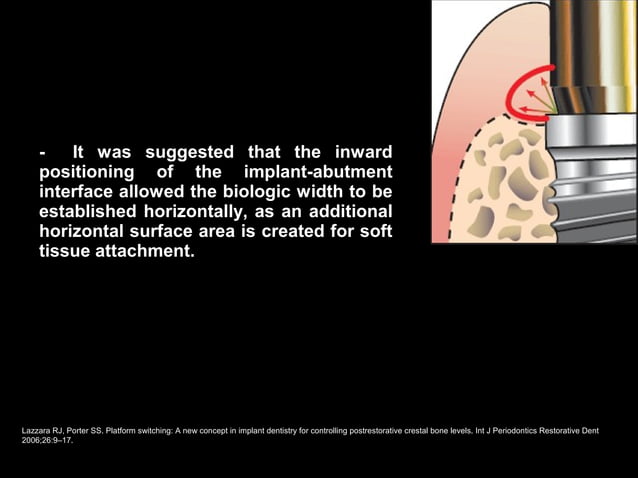 Evidence Based Prospection of Switching Platform in Dental Implants | PPT