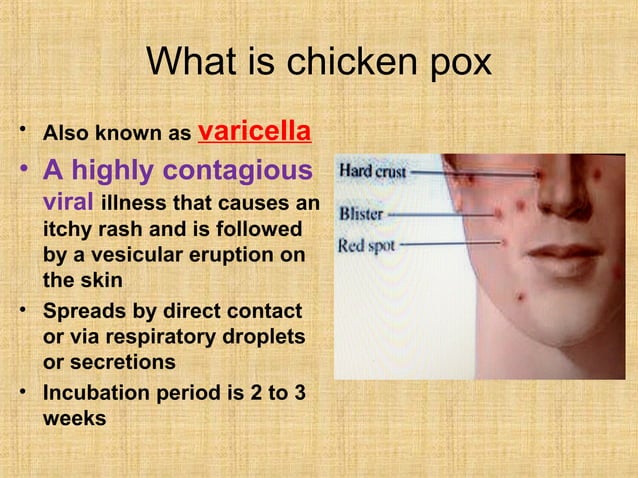 Evidence based treatment of chicken poc in pregnancy | PPT