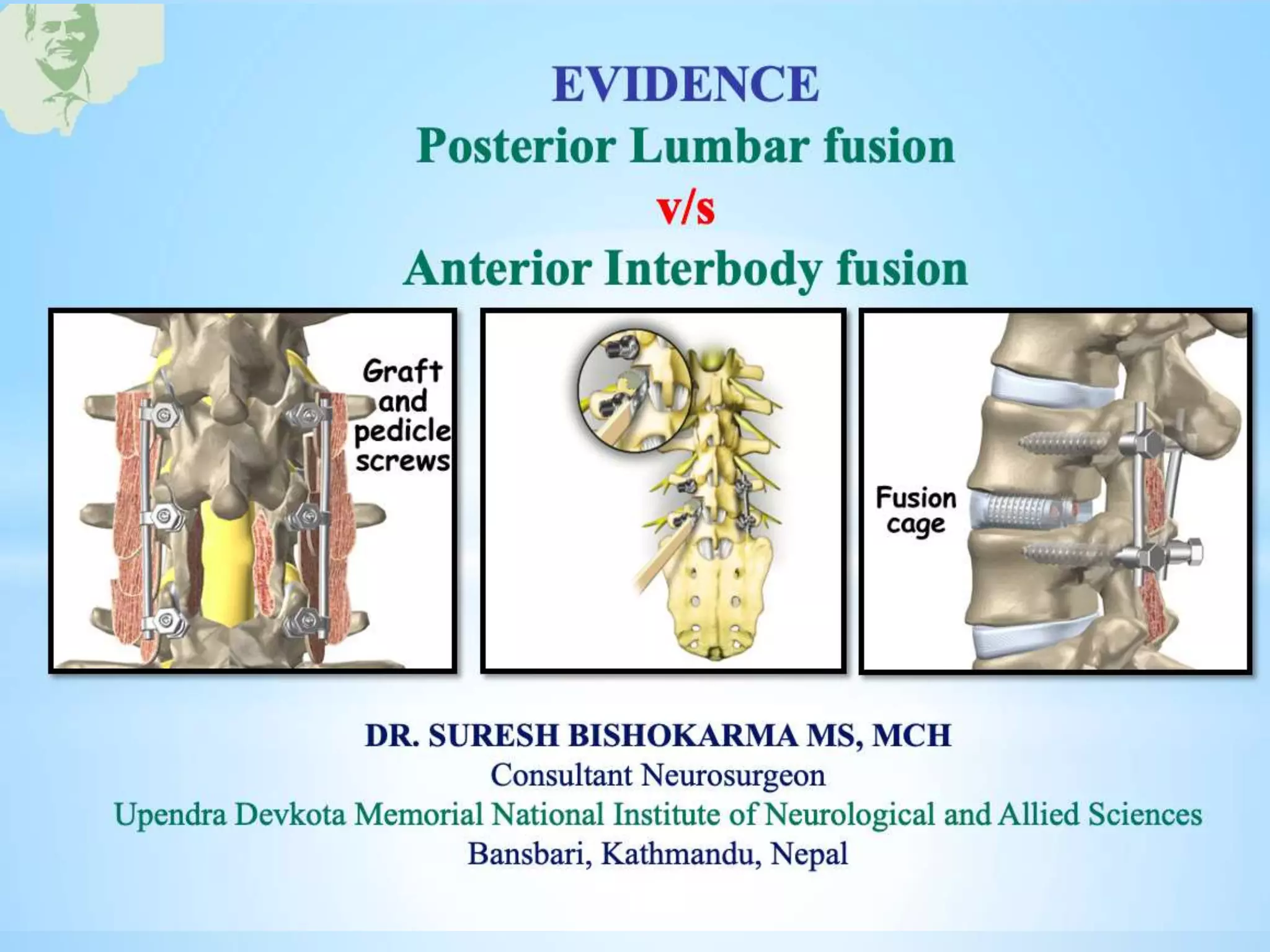Posterior lumbar fusion vs Lumbar interbody fusion Evidence based.pptx