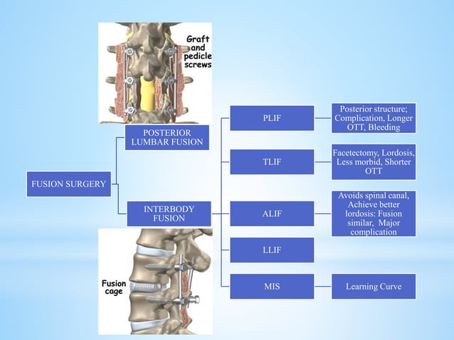 Posterior lumbar fusion vs Lumbar interbody fusion Evidence based.pptx
