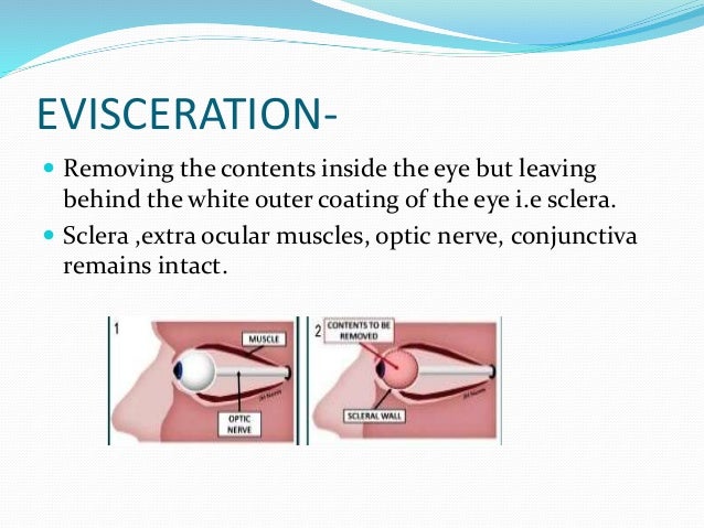 Evisceratio and enucleation(1)