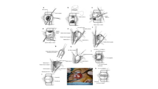 evisceration_enucleation presentation explained | PPTX
