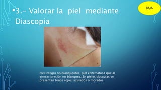 ULCERAS POR PRESIÓN (UPP) EVITANDO / EVARUCI | PPTX